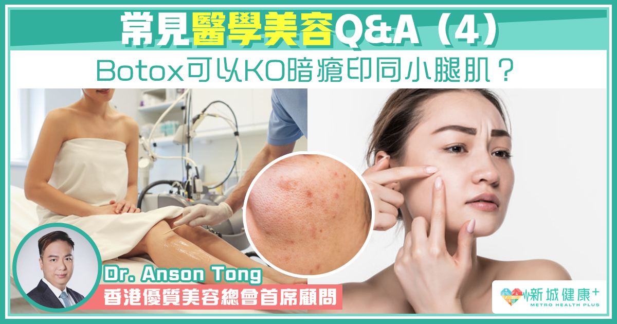 去暗瘡印同小腿肌都靠 Botox ？常見醫學美容Q&A（4）｜Dr. Anson Tong - 新城健康＋